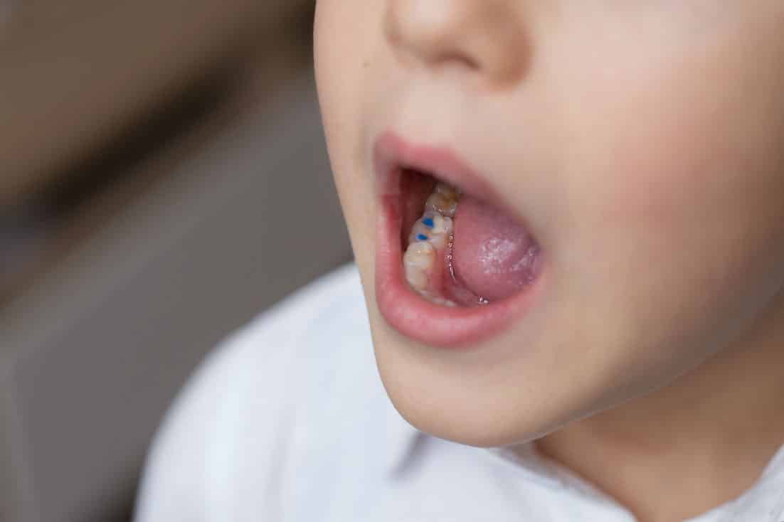 What to Do if Your Child's Filling Falls Out | Pediatric Dentistry of Burke